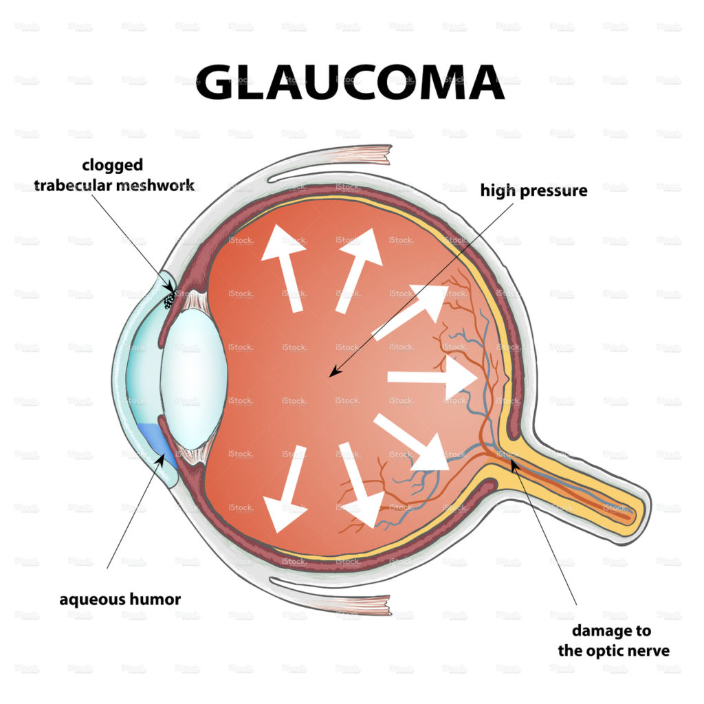 stock-illustration-75145213-glaucoma - PghEyeMeds